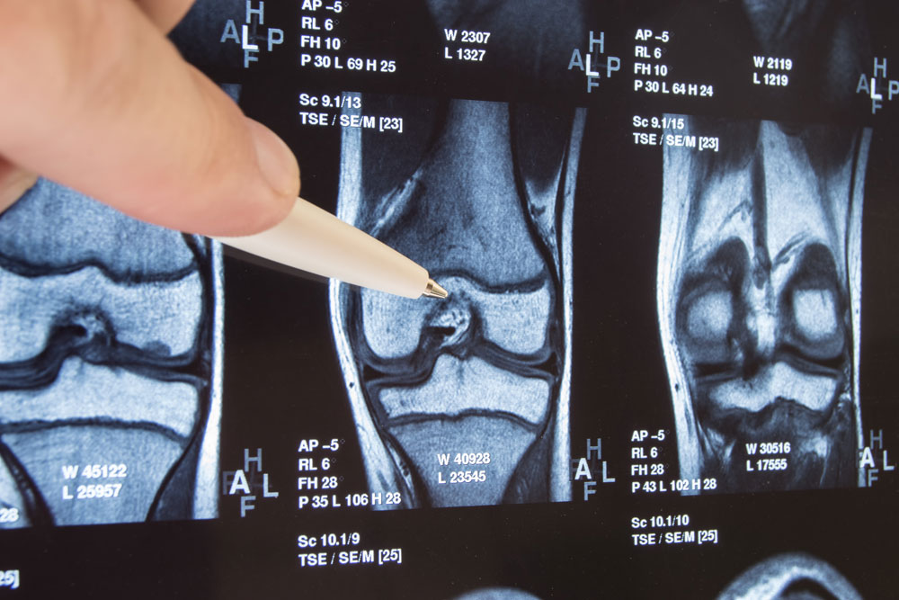 Partial Knee Replacement | Treatment of Knee Arthritis | Vail, Frisco, CO